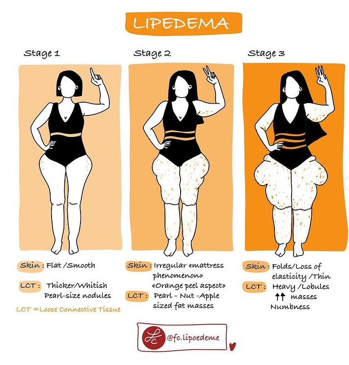 Lipedema – Lipedema Revolution